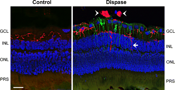 Involvement of Müller glial cells in epiretinal membrane formation ...