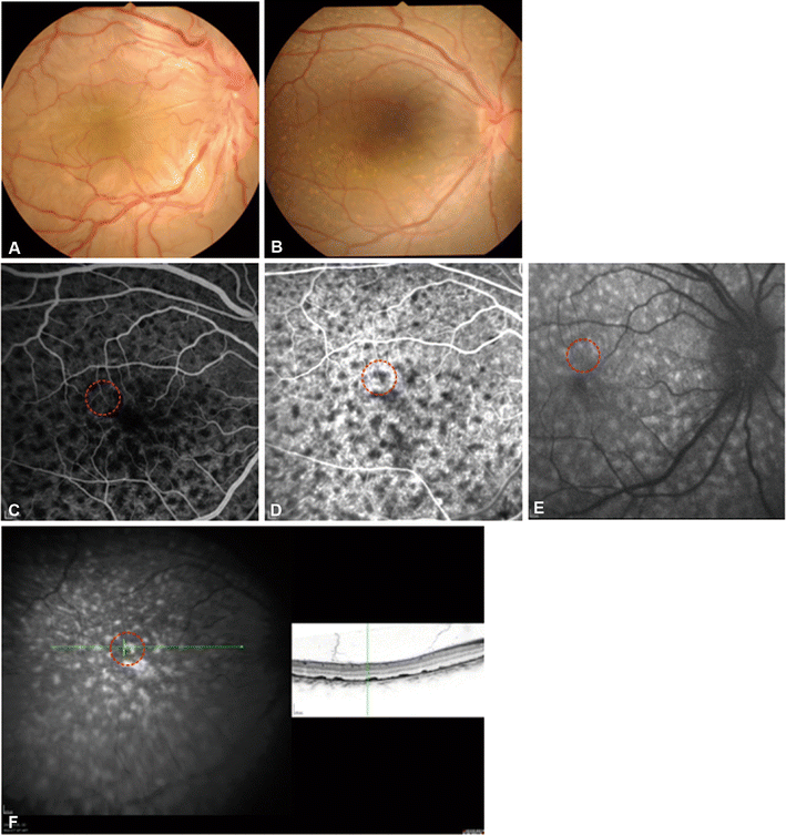 Fundus autofluorescence and spectral-domain optical coherence ...