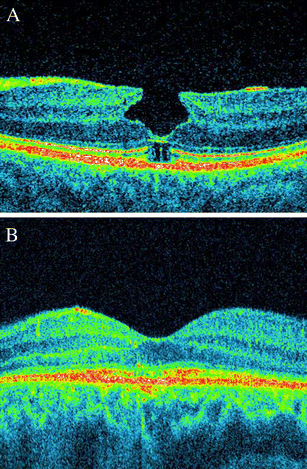 Surgical treatment of lamellar macular holes | SpringerLink