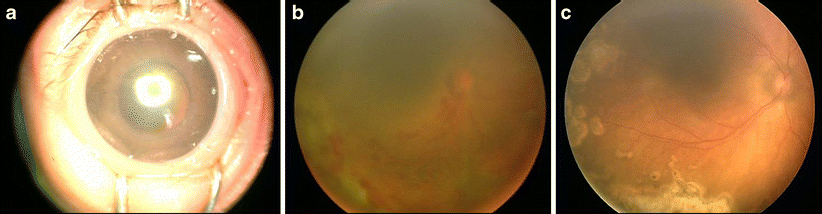 Intravitreal bevacizumab in combination with laser therapy for the ...