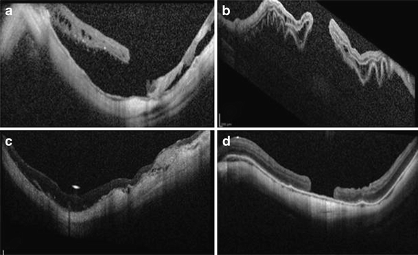 1000 cSt silicone oil vs heavy silicone oil as intraocular tamponade in ...