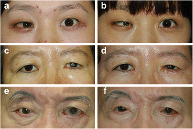 Treatment of refractory exposure keratitis with modified medial ...
