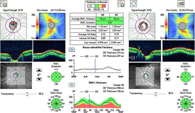 Biometry and spectral domain optical coherence tomography parameters in ...