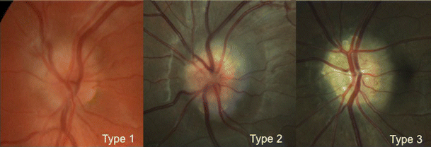 Visual field defects due to optic disk drusen in children | SpringerLink