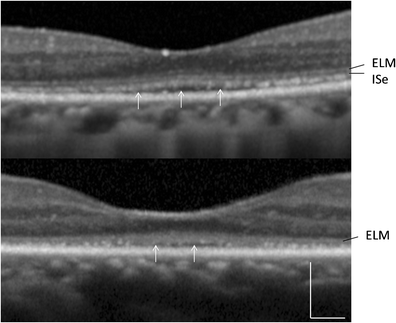 Tomographic comparison of cone-rod and rod-cone retinal dystrophies ...