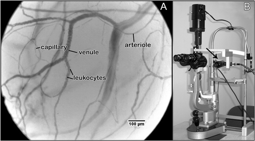 Orthogonal polarization spectral imaging of conjunctival ...