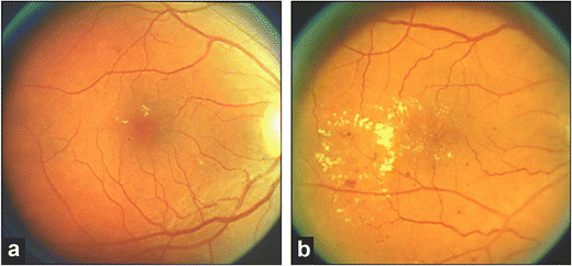 Effect of sulodexide in patients with non-proliferative diabetic ...