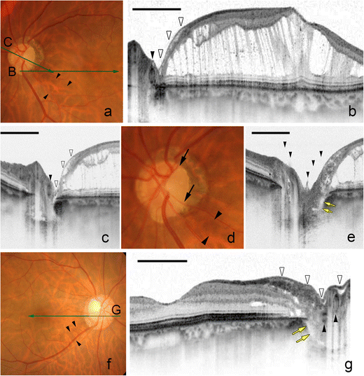 Macular retinoschisis associated with glaucomatous optic neuropathy in ...