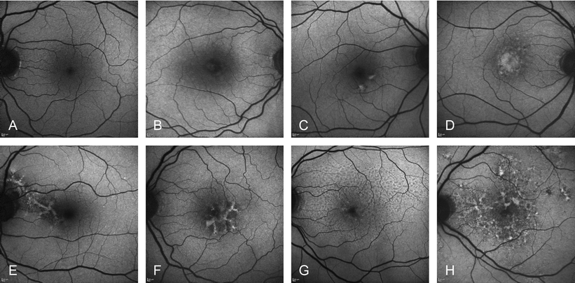 Fundus autofluorescence imaging in dry AMD: 2014 Jules Gonin lecture of ...