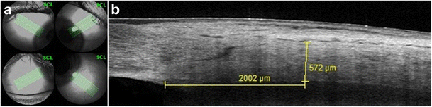 Metrics of the normal anterior sclera: imaging with optical coherence ...