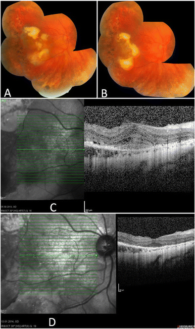 Anti-VEGF therapy in symptomatic peripheral exudative hemorrhagic ...