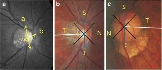 Optic disc tilt direction affects regional visual field progression ...