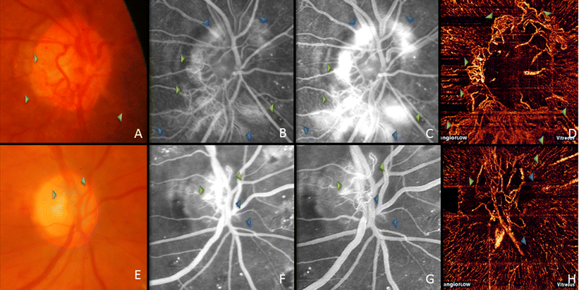 Morphological differences between optic disc collaterals and ...