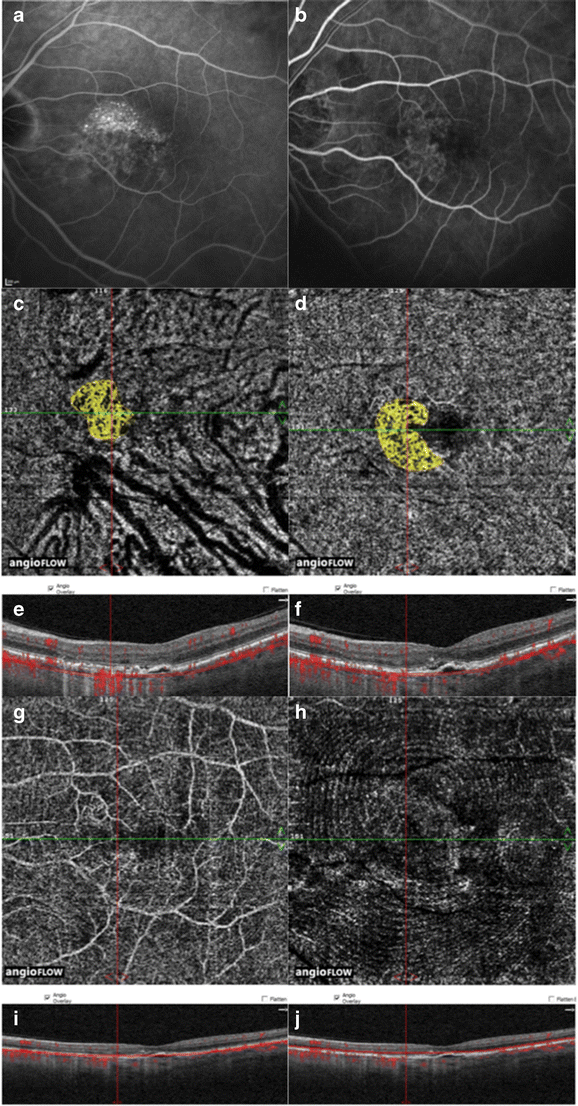Characteristics of type 1 and 2 CNV in exudative AMD in OCT-Angiography ...