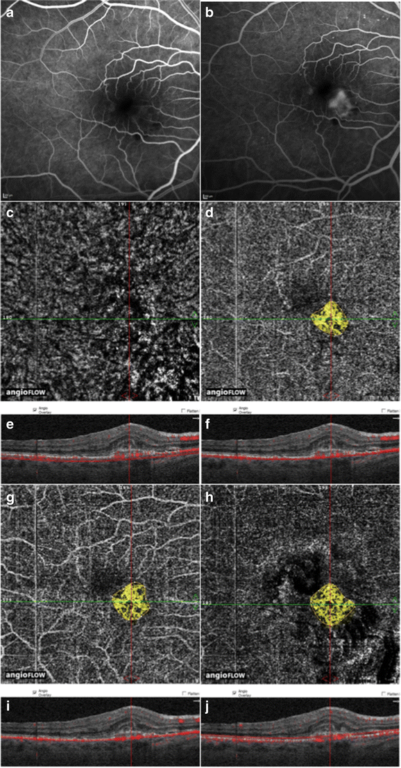 Characteristics of type 1 and 2 CNV in exudative AMD in OCT-Angiography ...