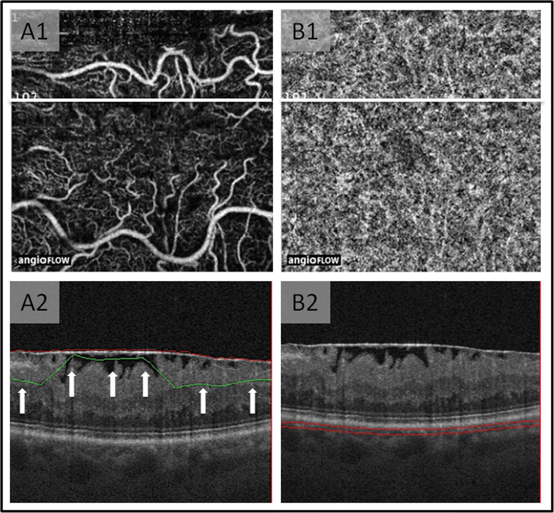 Prevalences of segmentation errors and motion artifacts in OCT ...