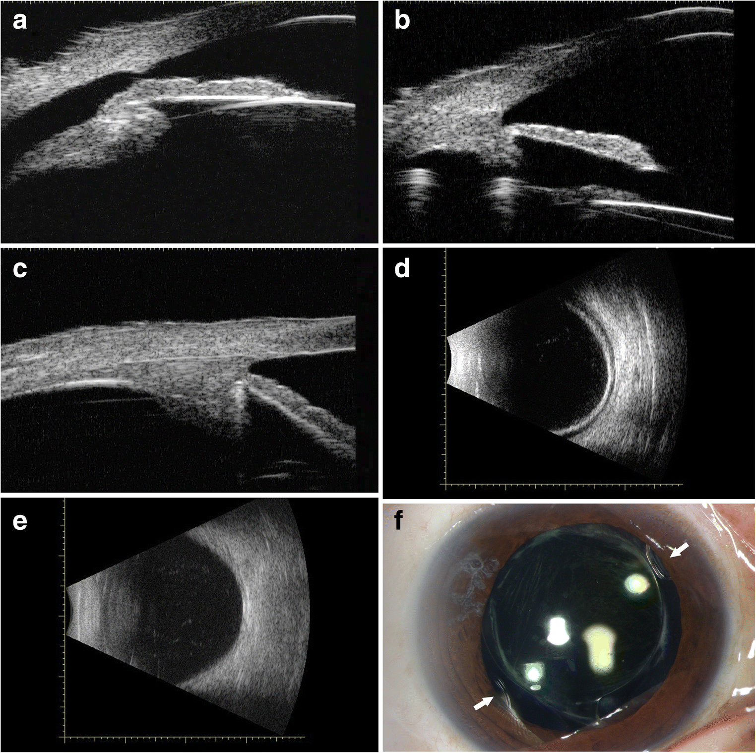 Cyclodialysis cleft repair and cataract management by ...