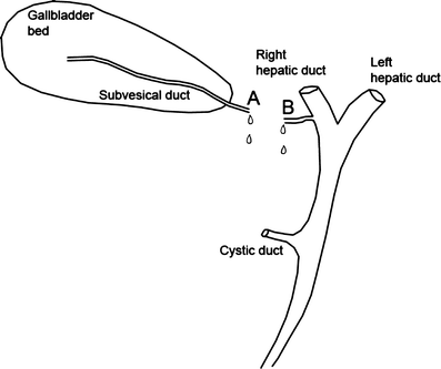 Bile leaks from the duct of Luschka (subvesical duct): a review ...