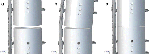 The dynamic locking screw (DLS) can increase interfragmentary motion on ...