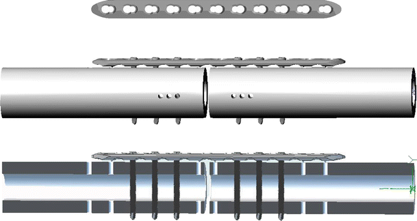 The dynamic locking screw (DLS) can increase interfragmentary motion on ...