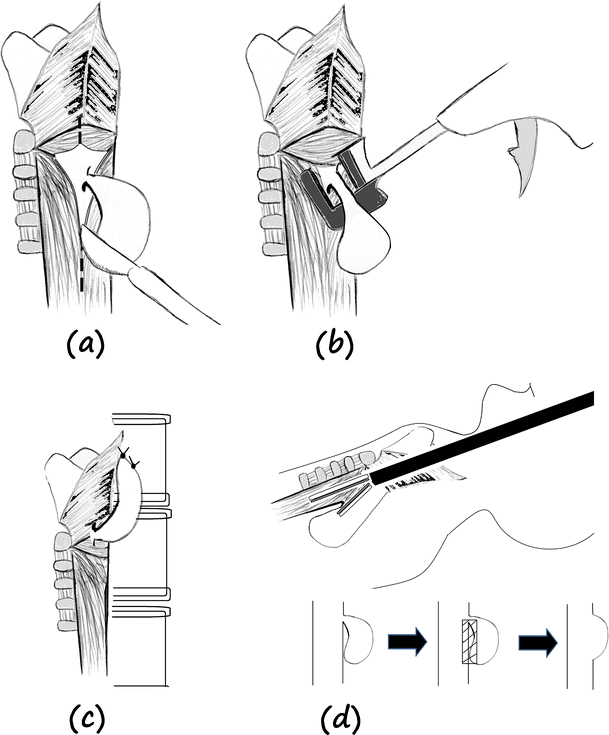 Modern pathophysiology and treatment of esophageal diverticula ...