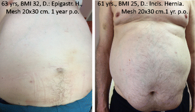 Endoscopic mini/less open sublay technique (EMILOS)—a new technique for ...