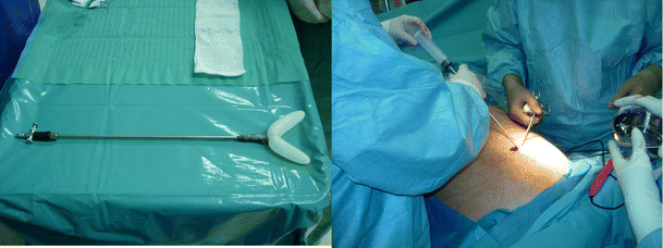 Endoscopic mini/less open sublay technique (EMILOS)—a new technique for ...