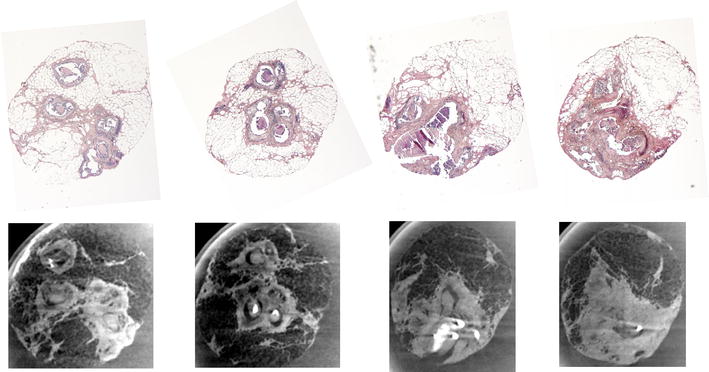 3-D reconstruction and virtual ductoscopy of high-grade ductal ...