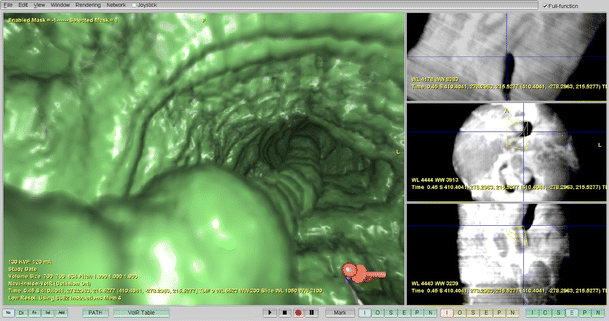 3-D reconstruction and virtual ductoscopy of high-grade ductal ...