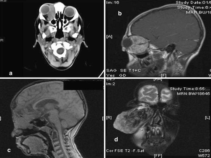 Extraconal orbital tumors in children—a spectrum | SpringerLink