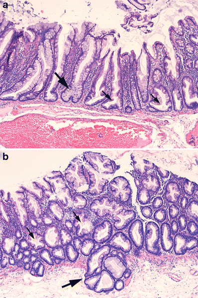 Serrated polyps of the colon and rectum (hyperplastic polyps, sessile ...