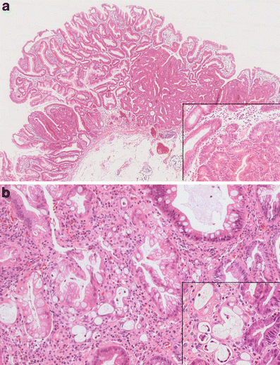 Serrated polyps of the colon and rectum (hyperplastic polyps, sessile ...