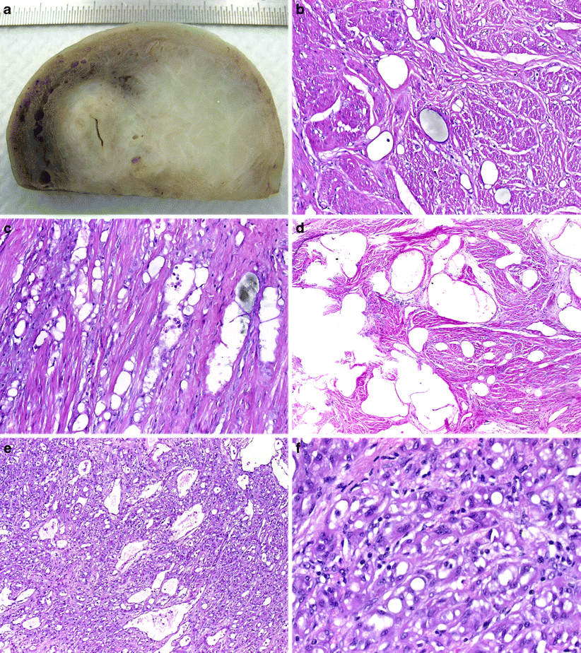 Adenomatoid Tumors Of The Female And Male Genital Tract A Comparative