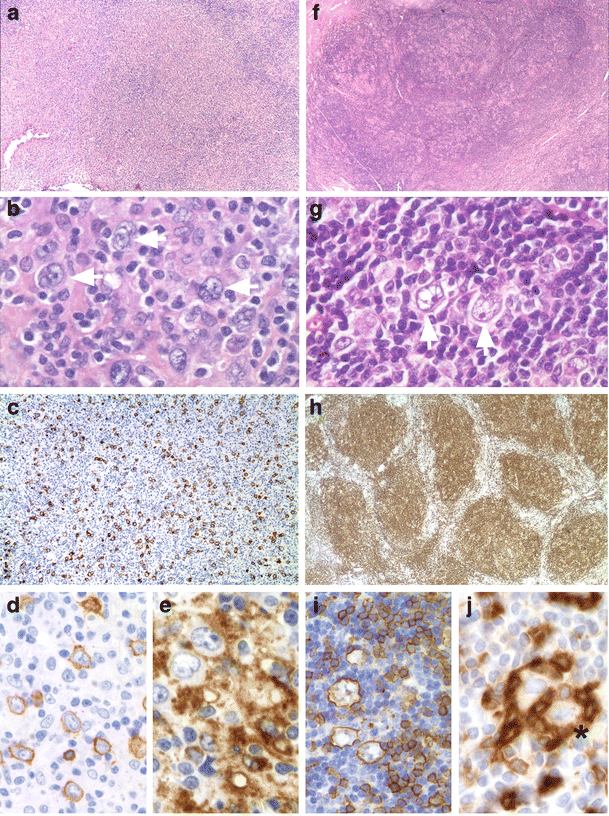T cell/histiocyte-rich large B-cell lymphoma: an update on its biology ...