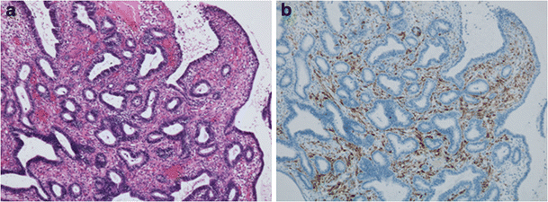 Stromal p16 expression differentiates endometrial polyp from ...
