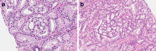 Cribriform morphology predicts upstaging after radical prostatectomy in ...