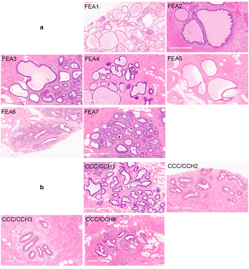 Does flat epithelial atypia have rounder nuclei than columnar cell ...