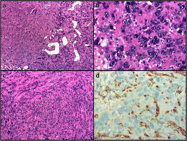 Fumarate hydratase (FH) deficiency in uterine leiomyomas: recognition ...