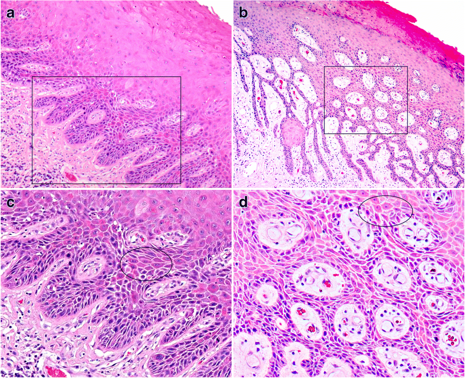 Differentiated vulvar intraepithelial neoplasia (dVIN): the most ...