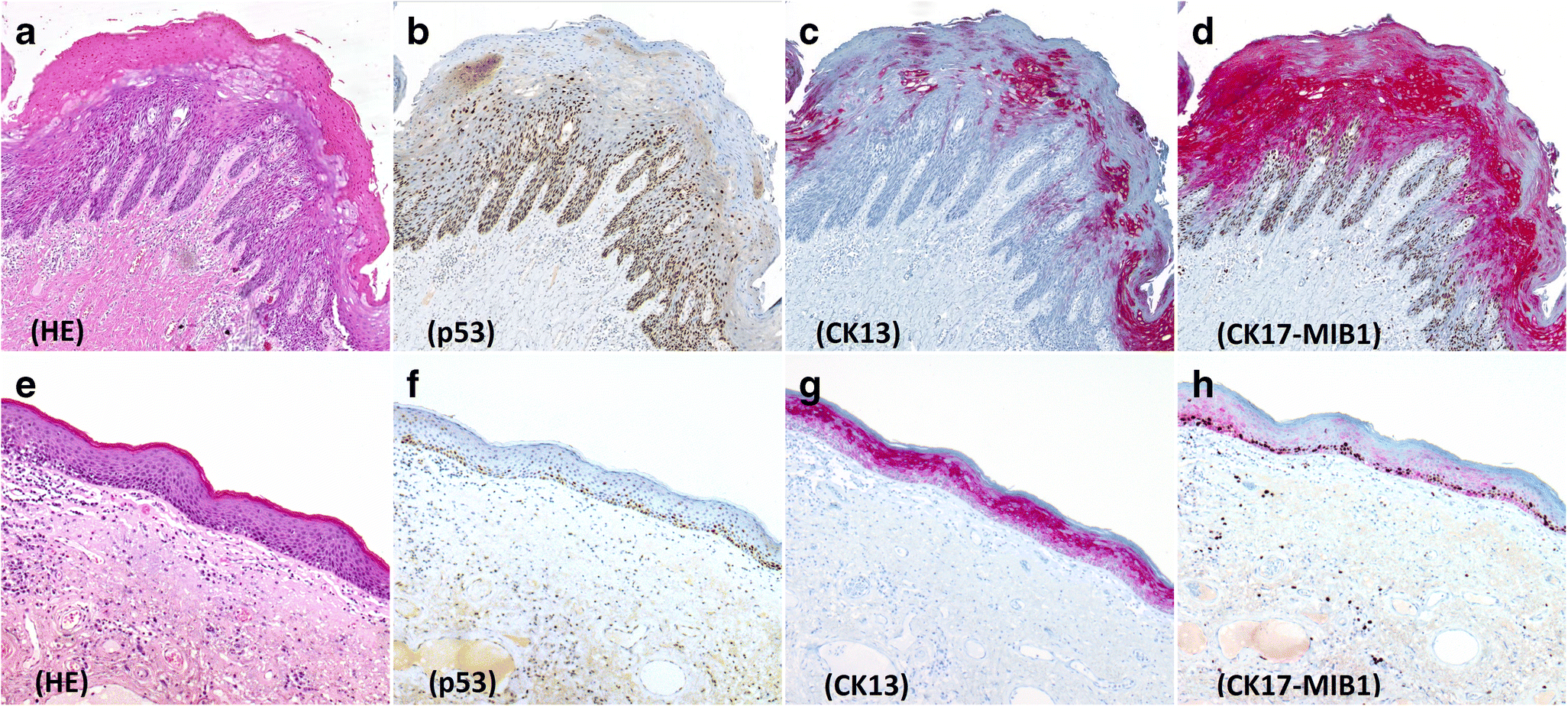 Differentiated vulvar intraepithelial neoplasia (dVIN): the most ...