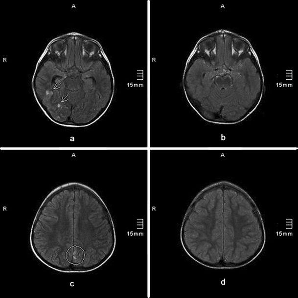 Hyperintense lesions in brain MRI after exposure to a mercuric chloride ...