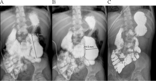 Serial transverse enteroplasty (STEP): intermediate outcomes in ...