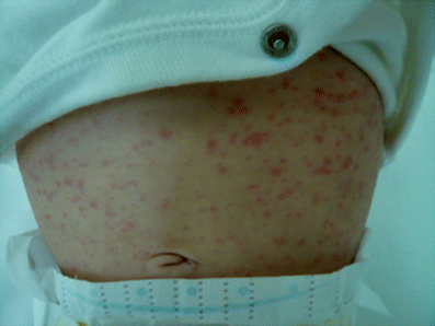 Maculopapular rash in the convalescent phase of Kawasaki disease: case ...