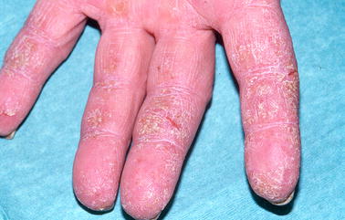 Acrokeratosis paraneoplastica of Bazex as an indicator for underlying ...