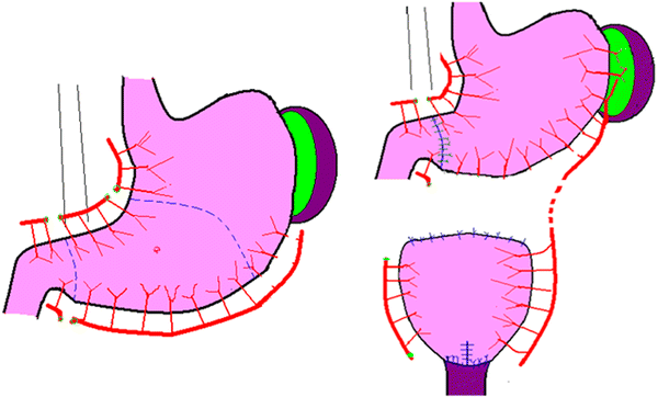 Laparoscopic radical cystectomy with orthotopic gastric neobladder ...