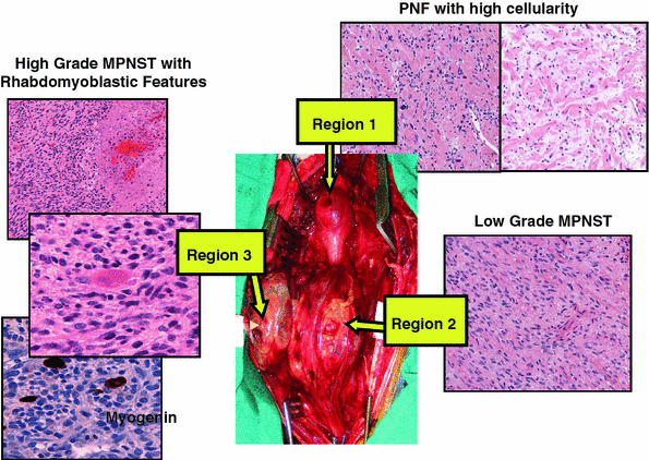 Molecular evolution of a neurofibroma to malignant peripheral nerve ...