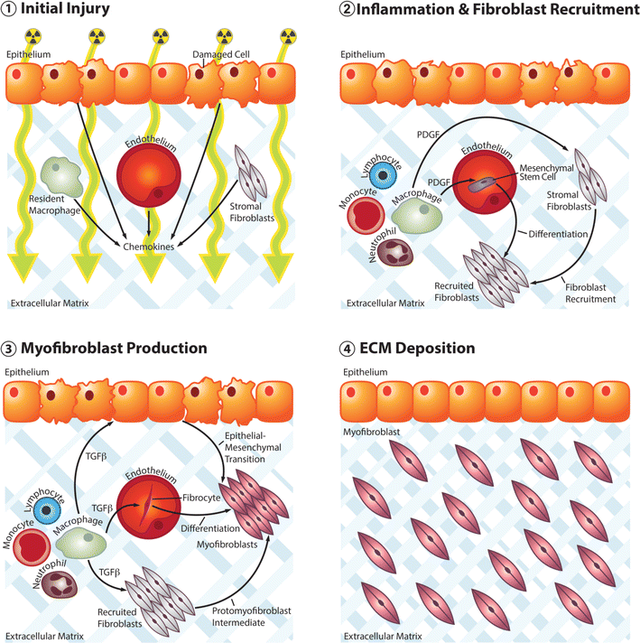 Radiation-induced fibrosis: mechanisms and implications for therapy ...