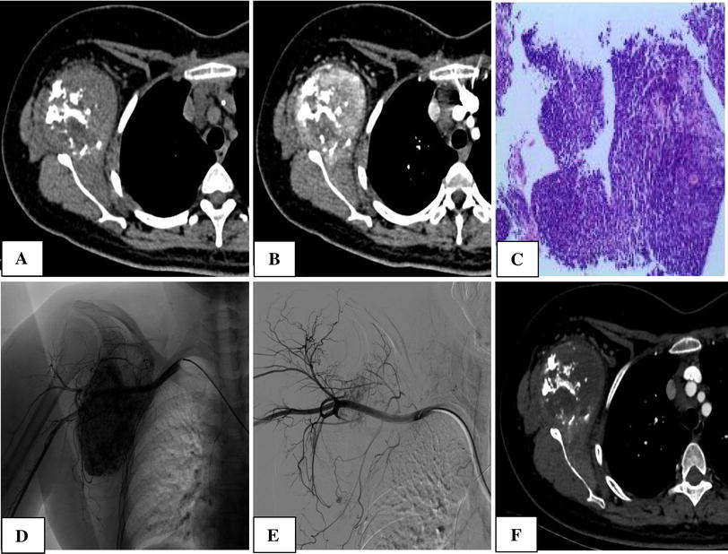 Drug-eluting bead transarterial chemoembolization in the treatment for ...