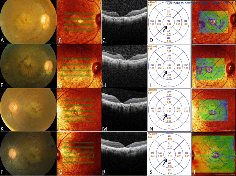 Treatment of retinitis pigmentosa due to MERTK mutations by ocular ...