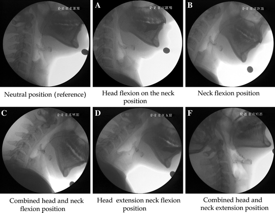 What Is the Chin-down Posture? A Questionnaire Survey of Speech ...